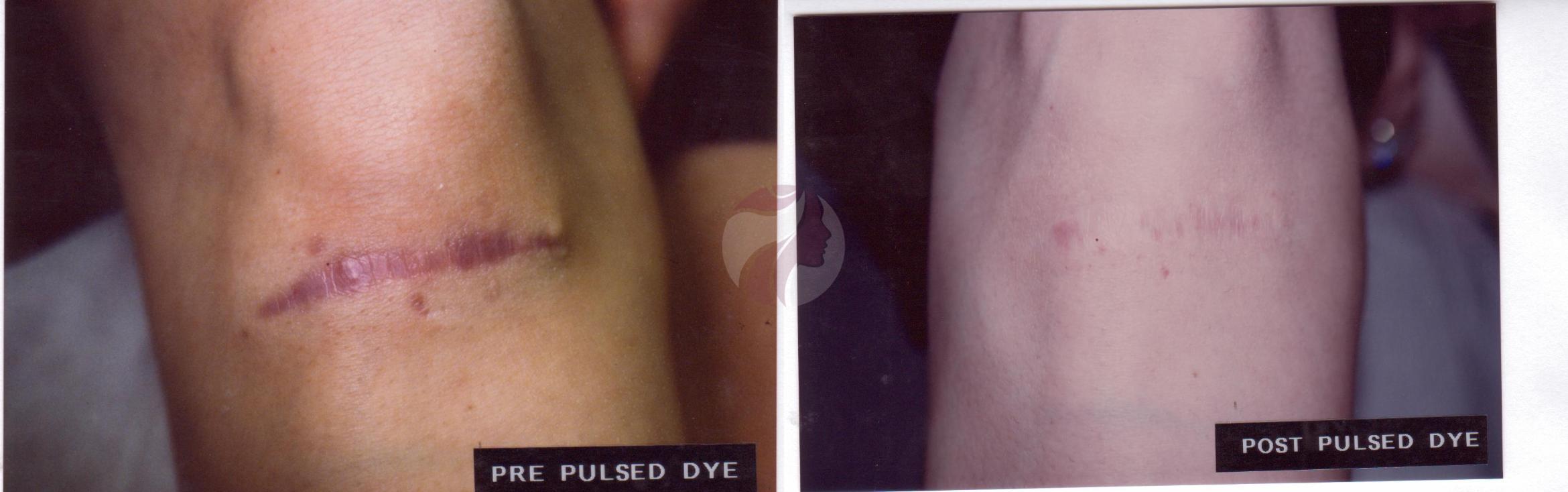 Pulsed Dye Laser Before & After Photos Patient 32 | Dallas, TX | Dallas ...